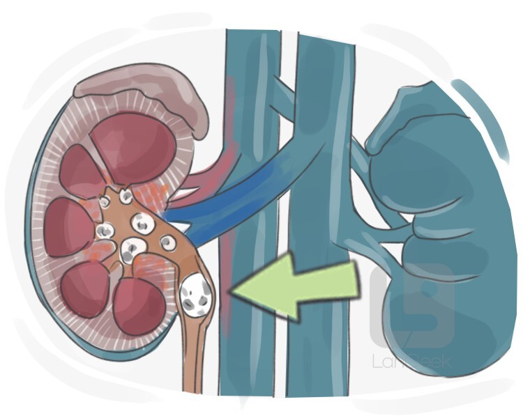 Definition Meaning Of Renal Calculus LanGeek